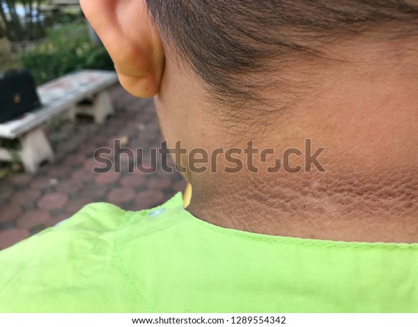 Black marks at the neck