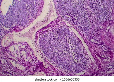 Bladder Transitional Cell Carcinoma Light Micrograph Stock Photo ...