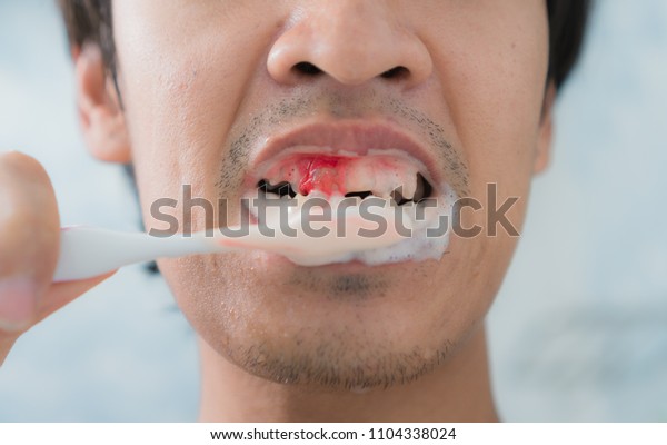 Bleeding at teeth during brushing with toothbrush.scurvy