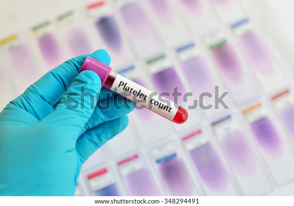 Blood Sample Platelet Count Test Stock Photo (Edit Now) 348294491