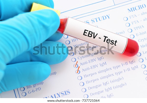 Blood sample with requisition form for Epstein-Barr virus (EBV) test