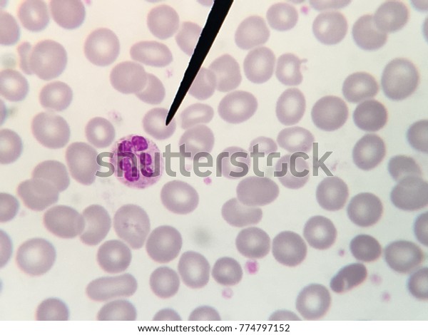 Blood Smear Showing Hyper Segmented Neutrophils Stock Photo (Edit Now ...