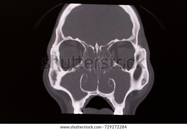 Bone window view CT scan in coronal / frontal cut of head & neck ...