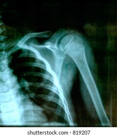 Bone Xray Stock Photo 819207 | Shutterstock