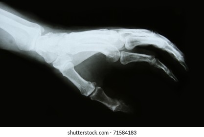 Bones Xrays Lights Stock Photo 71584183 | Shutterstock