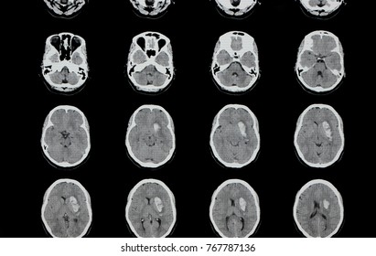 Brain Computer Tomography Ct Scan Patient Stock Photo 767787136 ...