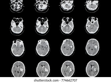 Brain Computer Tomography Ct Scan Patient Stock Photo 774662707 ...