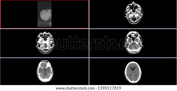 Brain Ct Scan Head Computed Tomography Stock Photo (Edit Now) 1390517819
