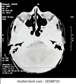 Brain Ct View Stock Photo 18188710 | Shutterstock