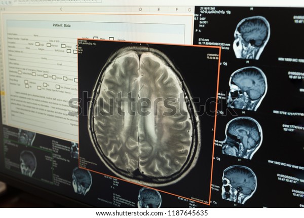 brain image on screen computer from CT scan or MRI scan. healthcare and ...