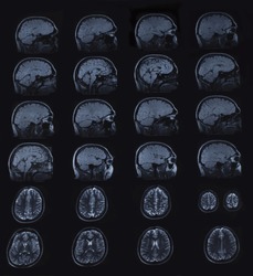 Glowing X-ray image of human brain in blue wireframe on isolated black ...