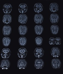 Glowing X-ray image of human brain in blue wireframe on isolated black ...