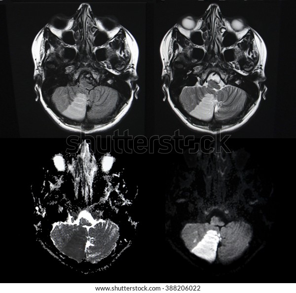 Brain Stroke Mri Stock Photo 388206022 | Shutterstock