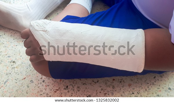 Broken Arm Bone Close Splinting Arm写真素材1325832002 | Shutterstock