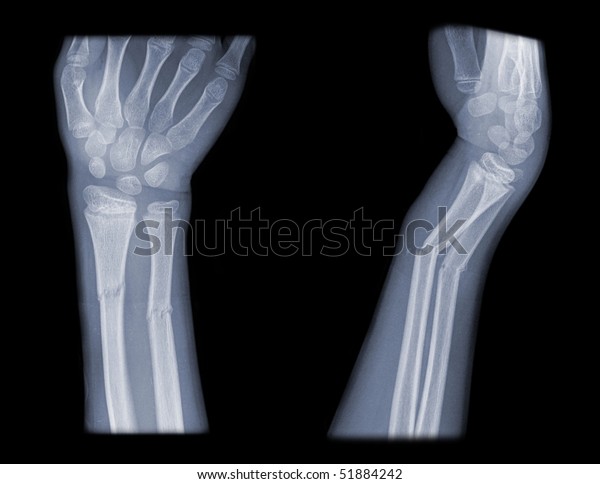 Broken Arm Side Front View On Stock Photo (Edit Now) 51884242