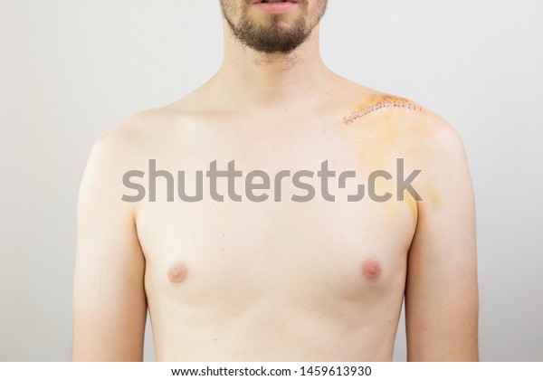 Broken Collarbone Clavicle Clavicula Post Surgery Stock Photo ... Broken Collarbone Clavicle Clavicula Post Surgery Stock Photo ...