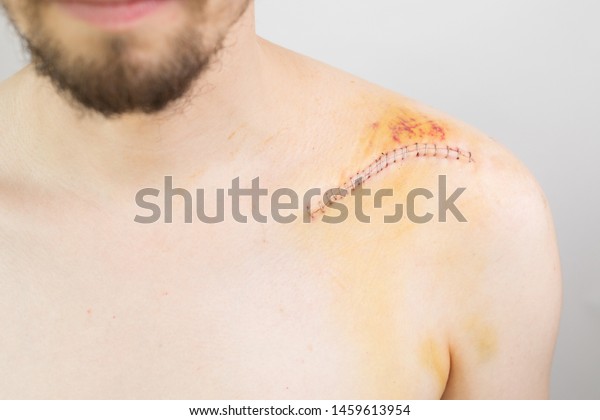 Broken Collarbone Clavicle Clavicula Post Surgery Stock Photo ... Broken Collarbone Clavicle Clavicula Post Surgery Stock Photo ...