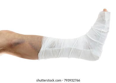 Leg Plaster Cast On White Background Stock Photo 90580930 | Shutterstock