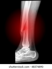 Broken Lower Leg Side View Red Stock Photo 48374890 | Shutterstock