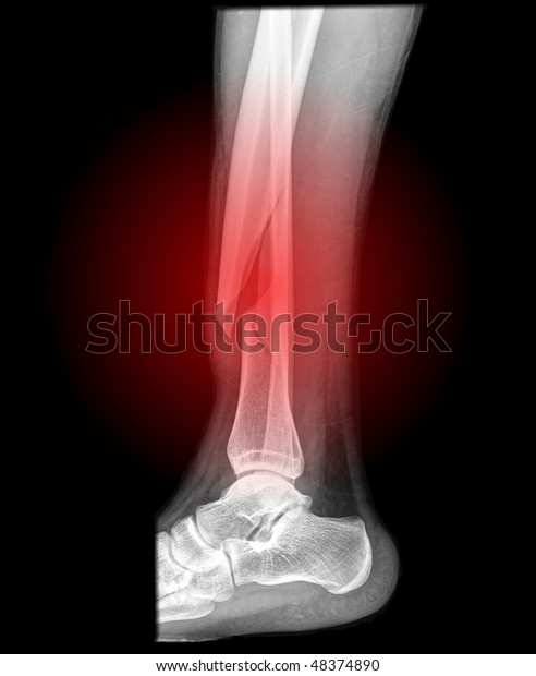 Broken Lower Leg Side View Red Stock Photo 48374890 | Shutterstock