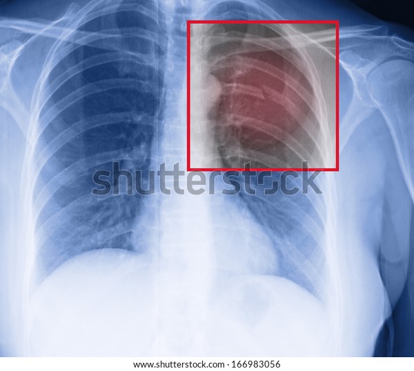 Broken Ribs Stock Photo (Edit Now) 166983056