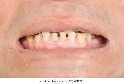 Close Photo Young Man Missing Teeth Stock Photo (Edit Now) 1833155686