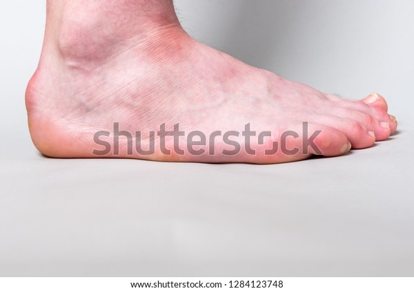 Bump On Back Heel Bone Called Stock Photo (Edit Now) 1284123748