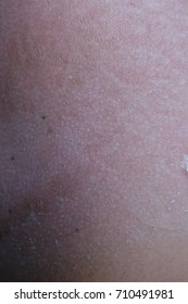 Burning Human Skin Stock Photo 710491981 | Shutterstock