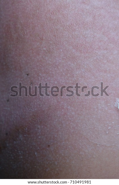 Burning Human Skin Stock Photo 710491981 | Shutterstock