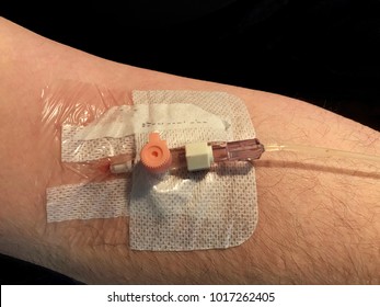 1,219 Intravenous cannula Images, Stock Photos & Vectors | Shutterstock