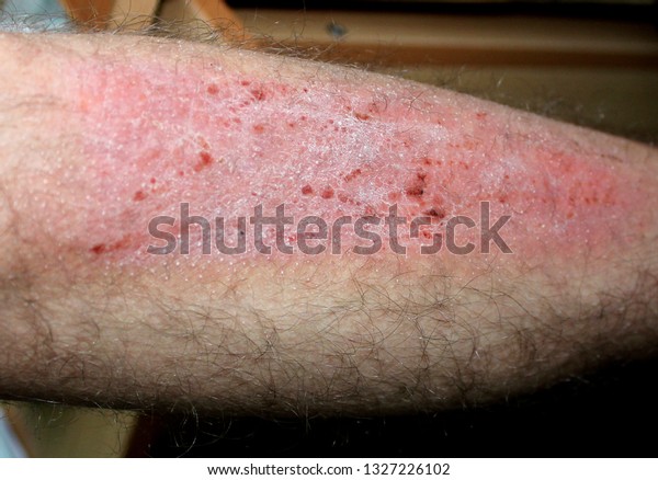 10 Lichen Simplex Chronicus Bilder, Stockfotos und Vektorgrafiken ...