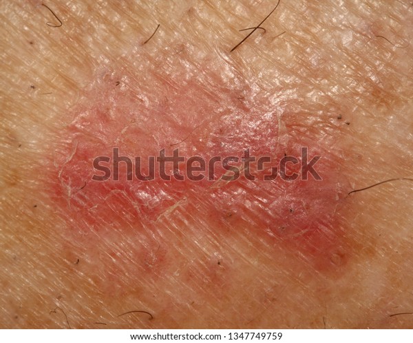 Case Squamous Cell Carcinoma Situ Bowens Foto De Stock 1347749759