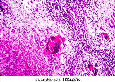 77 Caseous necrosis Images, Stock Photos & Vectors | Shutterstock