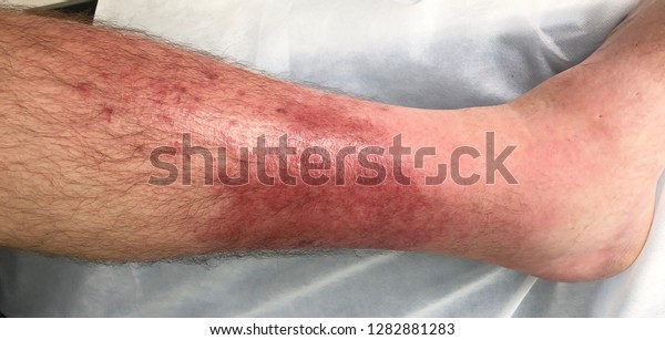 Cellulitis Left Leg Stock Photo (Edit Now) 1282881283