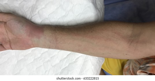 Lymphangitis Images, Stock Photos & Vectors | Shutterstock