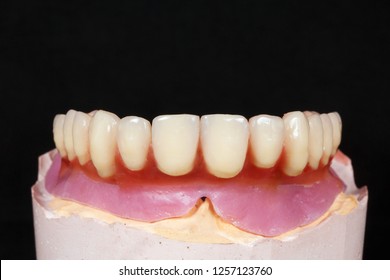 Ceramic Prosthesis Artificial Maxillary Gingiva Foto Stok 1257123760 ...