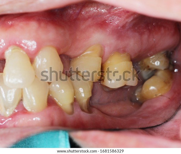 Cervical Abfraction Theoretical Concept Explaining Loss Stock Photo ...