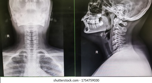 Xray Cervical Spine Lateral Views2 Views ภาพสต็อก 1464265013 | Shutterstock