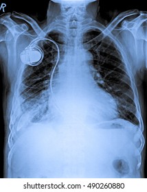 Chest X Ray Pacemaker Stock Photo 490260880 | Shutterstock