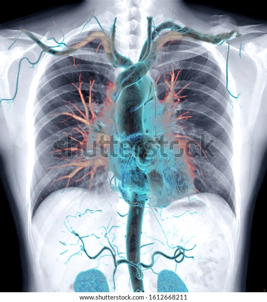 Chest Xray 3d Rendering Image Cta Stock Photo (Edit Now) 1612668211