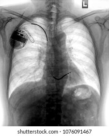 89 Permanent Pacemaker Images, Stock Photos & Vectors | Shutterstock