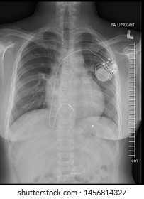 89 Permanent Pacemaker Images, Stock Photos & Vectors | Shutterstock