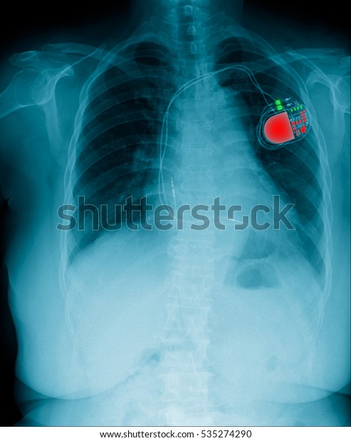 Chest Xray Show Pacemaker Cell Stock Photo 535274290 | Shutterstock