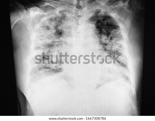 Chest X-ray showing diffuse widespread ground-glass,recticulonodular ...