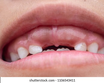 189 Two front teeth missing Images, Stock Photos & Vectors | Shutterstock