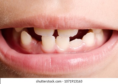2,480 Missing front teeth Images, Stock Photos & Vectors | Shutterstock