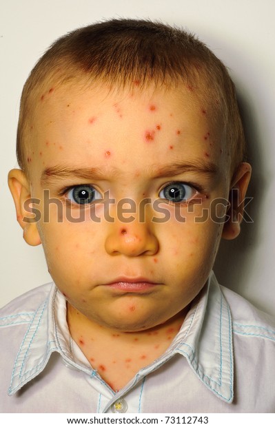Child Pockmarks Smallpox Stock Photo 73112743 | Shutterstock