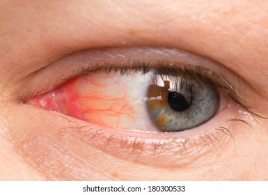Close Eyelids Infection Hordeolum Stye Abscess Stock Photo (Edit Now ...