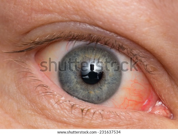 Chronic Conjunctivitis Eye Red Iris Pus Stock Photo 231637534 ...