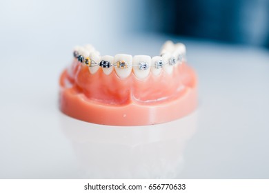 Dental Jaw Model Braces Brackets Stock Photo 581411413 | Shutterstock
